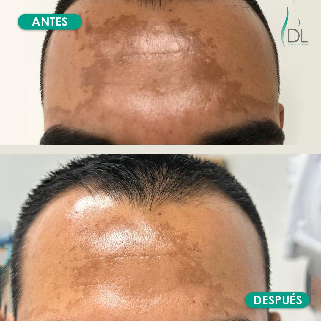 Manchas en la Piel - Dermatologica Laser and Cosmetic
